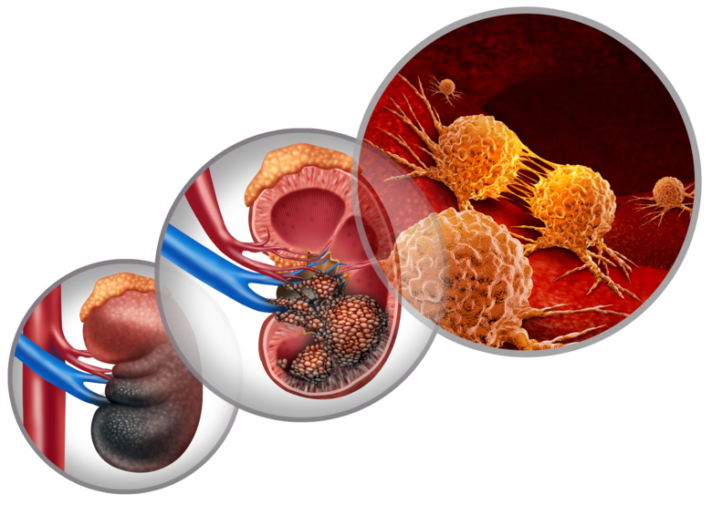 Gene signature points to prognosis in kidney cancer | Karolinska Institutet