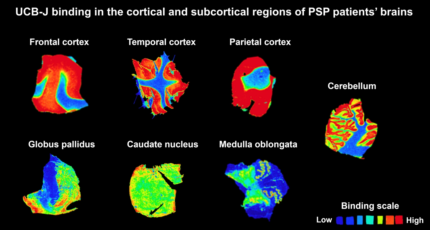 New study sheds light on Progressive Supranuclear Palsy | Karolinska Institutet