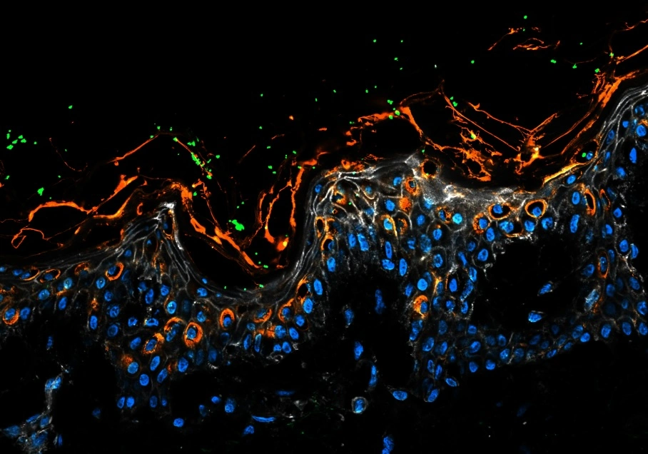 How human skin differentiates bacterial friend from foe | Karolinska ...