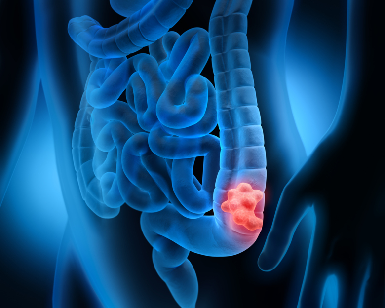 Colorectal cancer risk remains despite modern treatment for ulcerative ...
